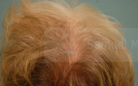 Dallas Female Hairline Lowering Before and After Photos - Plano Plastic ...