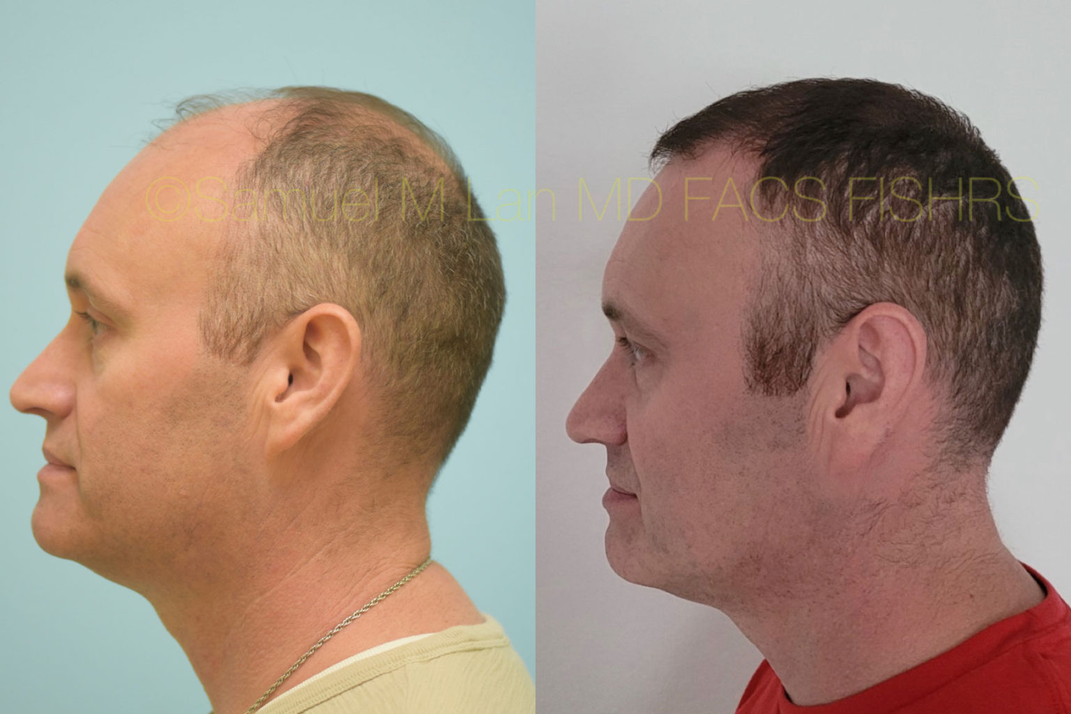 Dallas Crown (Vertex) Hair Restoration Before and After Photos - Plano ...