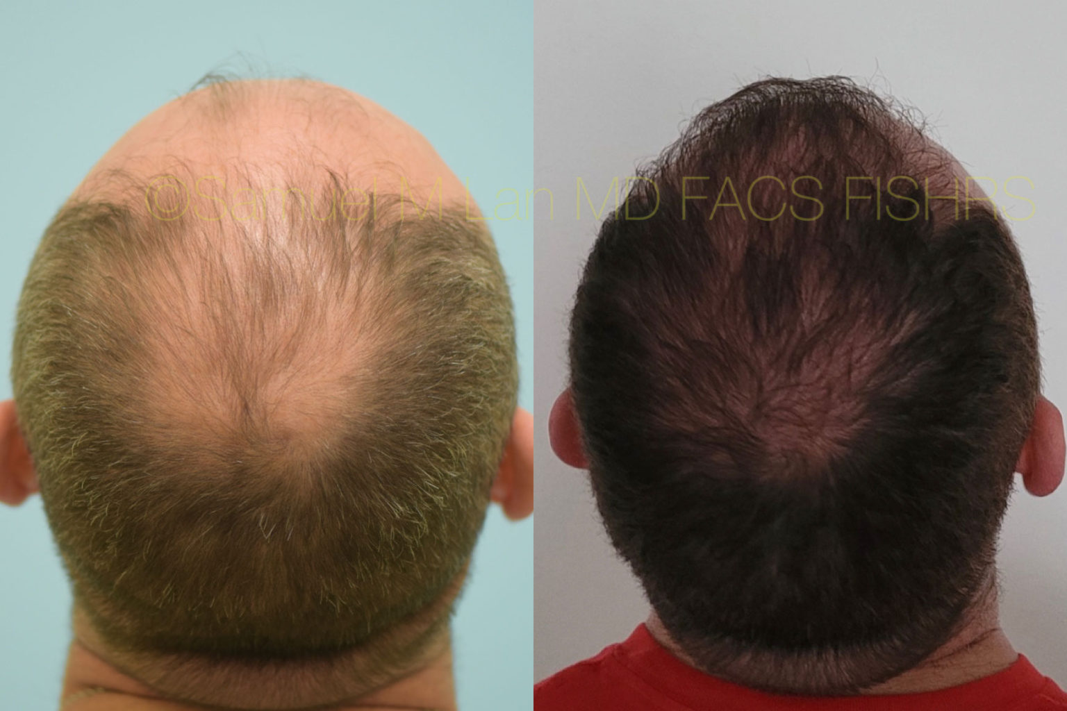 Dallas Crown (Vertex) Hair Restoration Before and After Photos - Plano ...