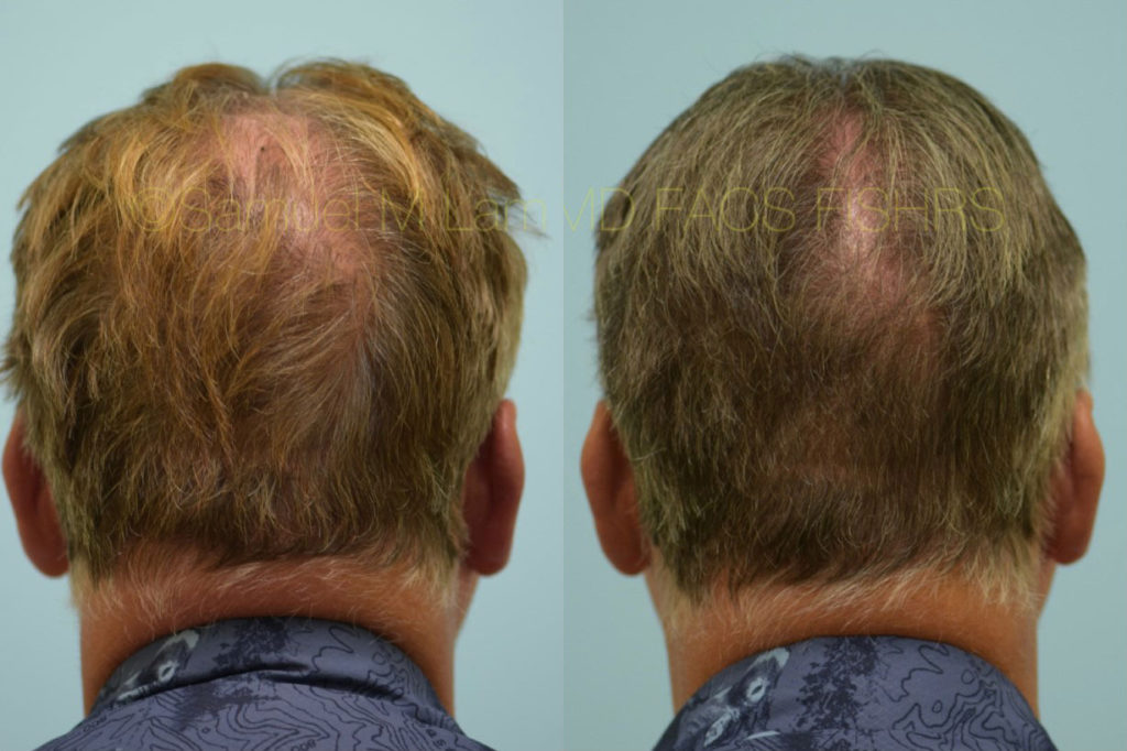 Dallas Crown (Vertex) Hair Restoration Before and After Photos - Plano ...