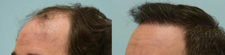 Dallas Crown (Vertex) Hair Restoration Before and After Photos - Plano ...