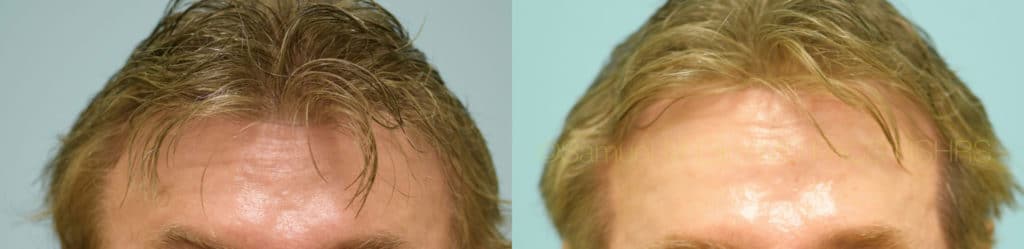 Dallas Hairline and Central Density Hair Restoration Before and After ...
