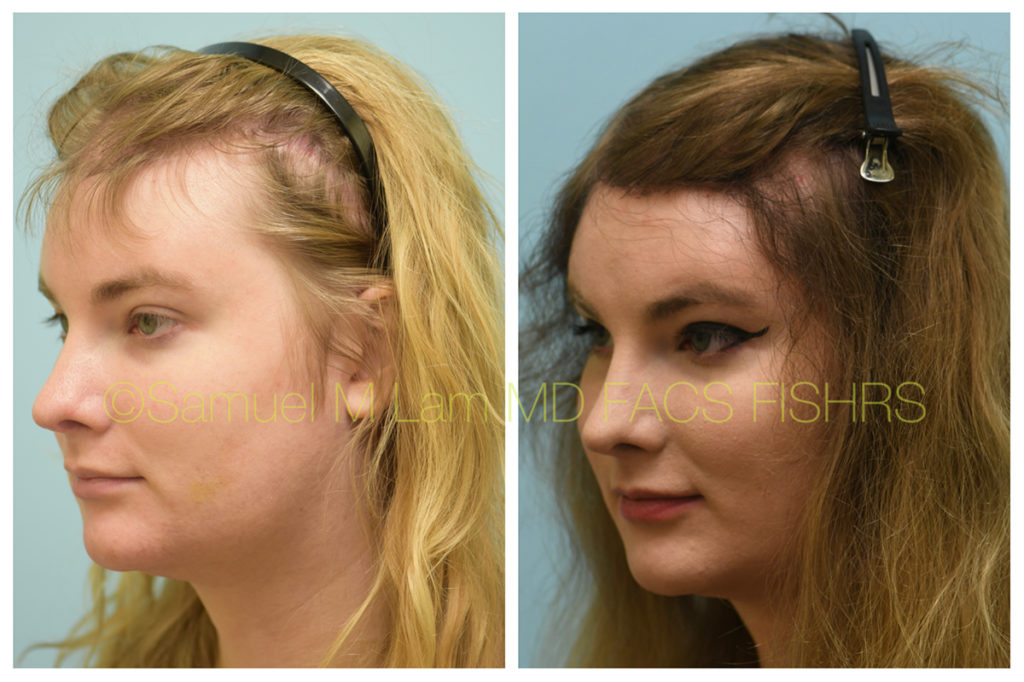 Dallas Scar Repair Before and After Photos - Plano Plastic Surgery ...