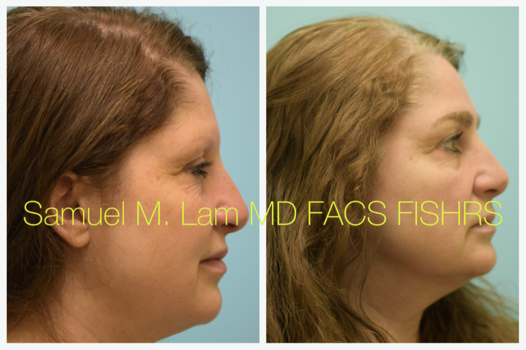 Eyebrow Hair Transplant Gallery | Lam Institute for Hair Restoration