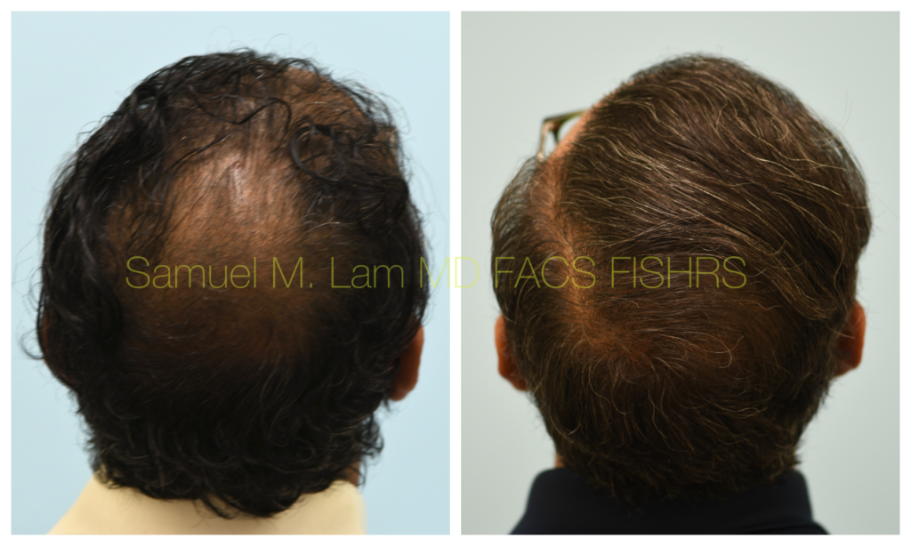 Ethnic Female Hair Transplant Gallery | Lam Institute for Hair Restoration