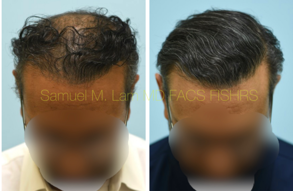 Ethnic Female Hair Transplant Gallery | Lam Institute for Hair Restoration