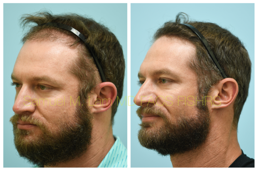 Before & After Crown & Vertex Hair Restoration | Lam Institute For Hair ...