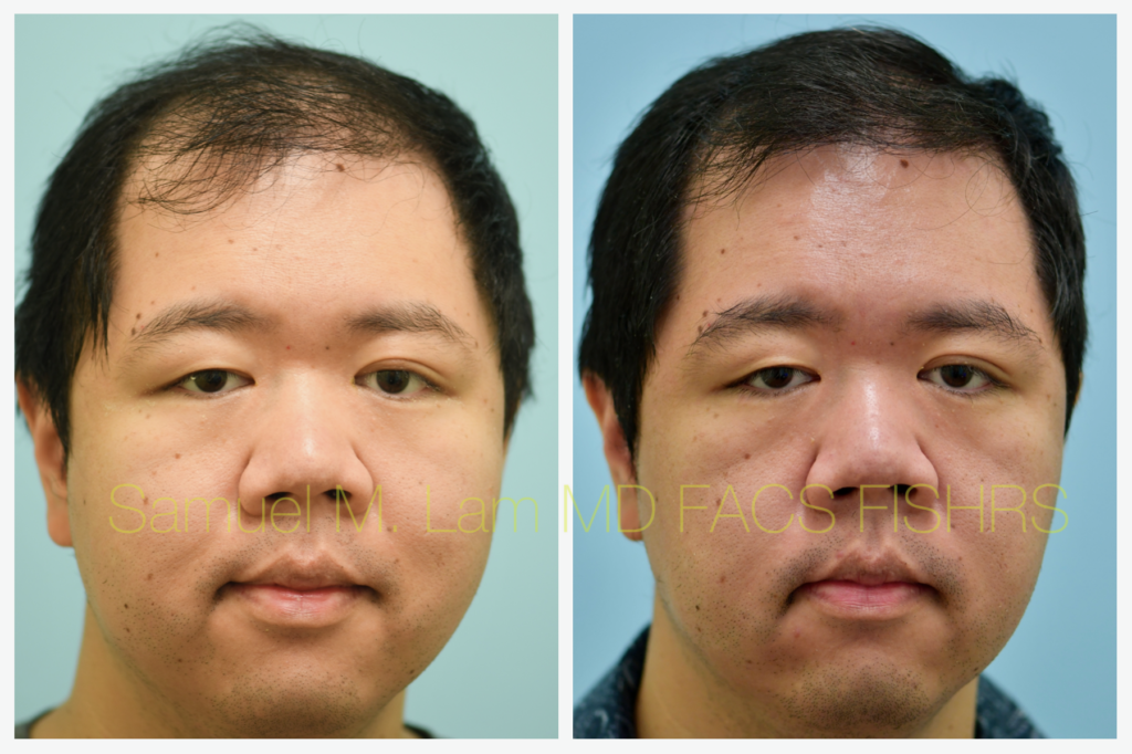 Scalp Micropigmentation (SMP) Gallery | Lam Institute for Hair Restoration